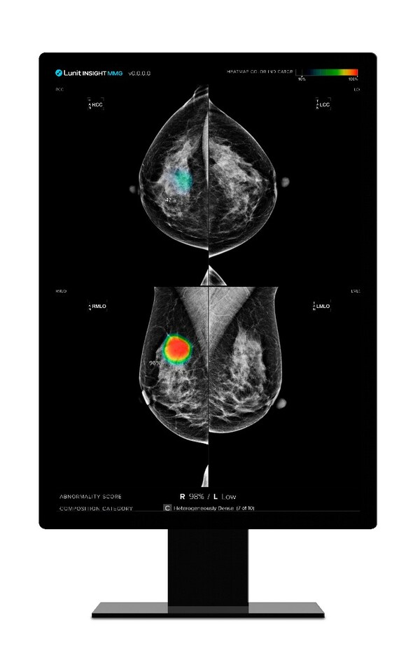 Lunits Ai Powered Mammography Analysis Solution Proves Comparable To